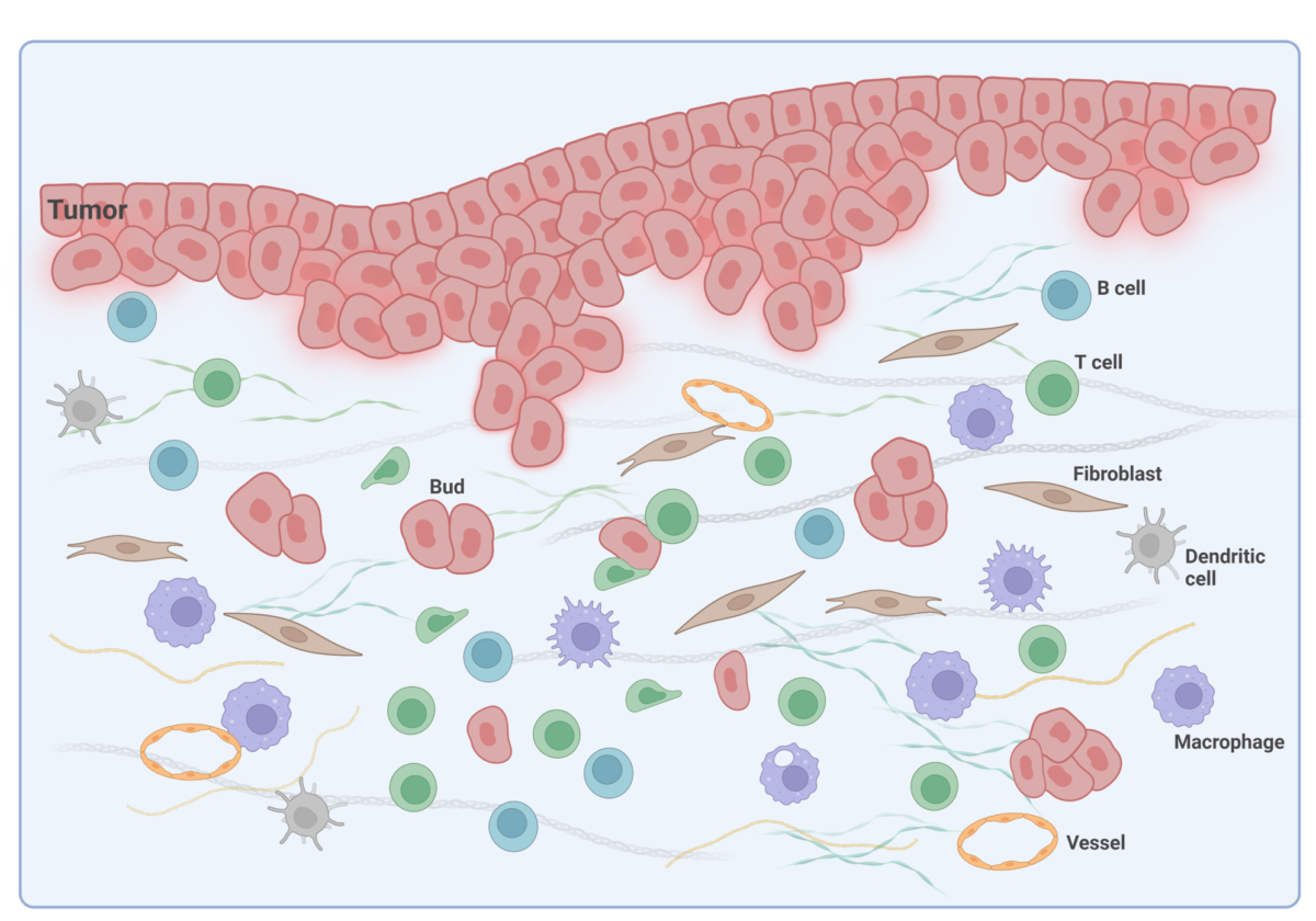 Deepening understanding of tumor budding in colorectal cancer for ...