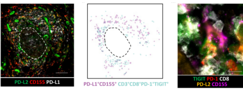 Uncovering the mechanisms behind immune evasion in pancreatic cancer with multiplex ...