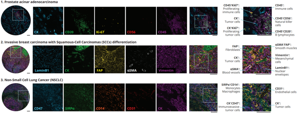 Exploring spatial insights between tumor and stroma with multiplex immunofluorescence ...