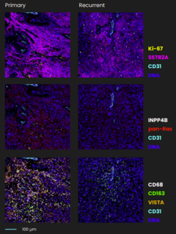 The spatial edge in meningioma research - Lunaphore Technologies